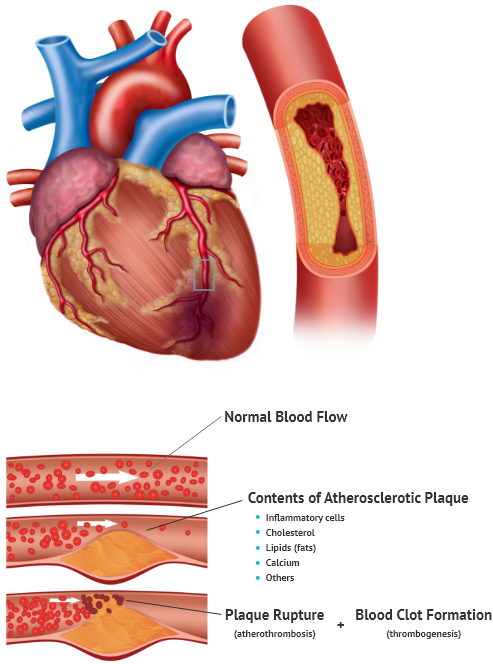 Coronary Artery Disease Elite Cardiovascular Group