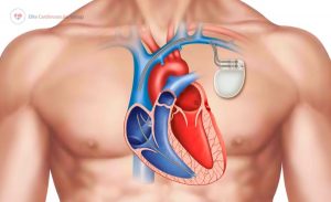 Pacemaker / Defibrillator Interrogation - Elite Cardiovascular Group