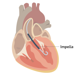Impella - Elite Cardiovascular Group