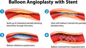 Percutaneous Coronary Angioplasty (PCI) - Elite Cardiovascular Group